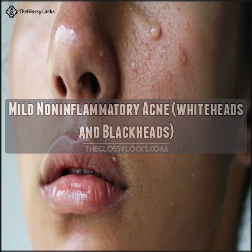 Effective Acne Treatment for Oily Skin: 8 Must-Try Products in 2025